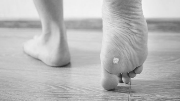 Verrucae Removal Bristol | Expert Treatment 4 Verrucas